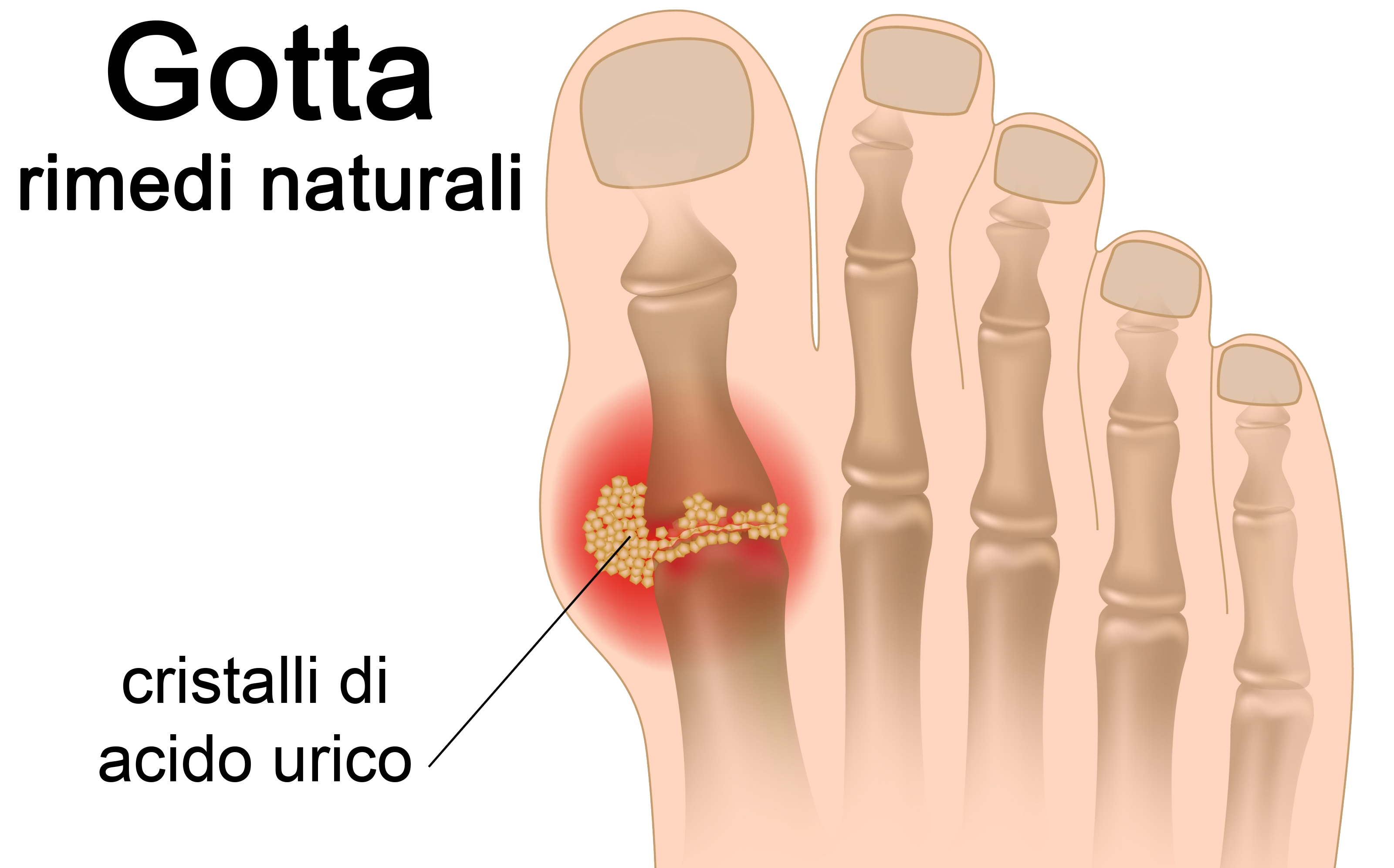 La Gotta: prodotti naturali per prevenire l'eccesso di acido urico